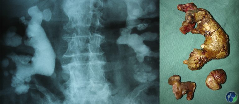 cálculo coraliforme 866_378 (2) - Clínica Dr. Examina - Especialidades ...